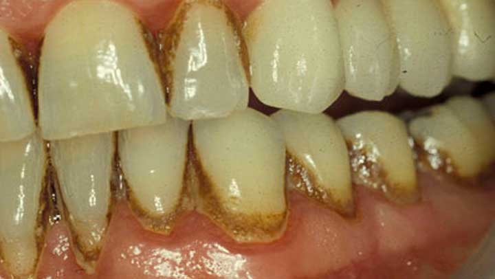 Cuando veas este metodo te enojas con tu dentista por ocultarte que ...