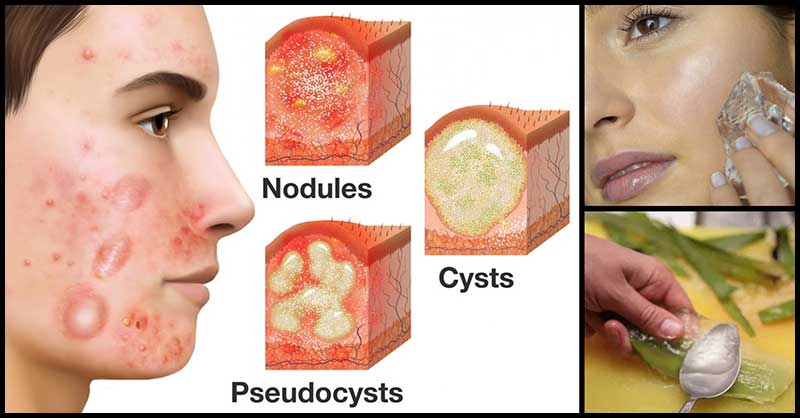 Effective Home Remedies Against Cystic Acne Dr Farrah Md
