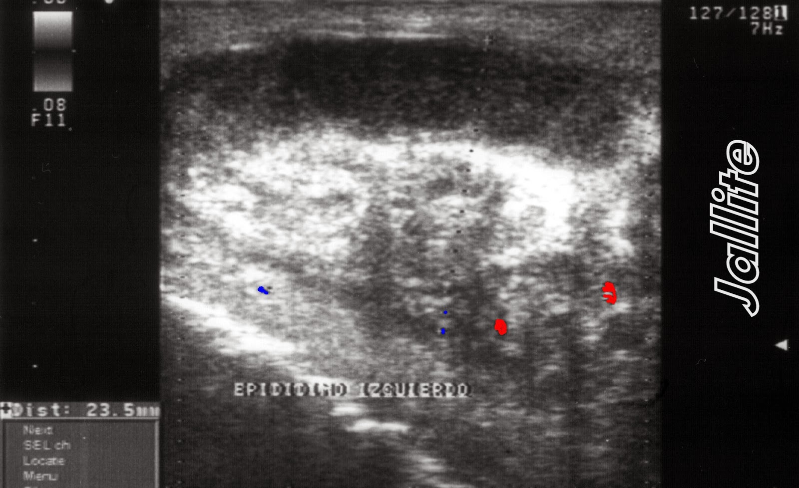 Orqui-Epididimitis Aguda