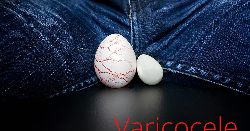 Varicocele Symptoms, Causes and Treatment - Just Call Me, Adi