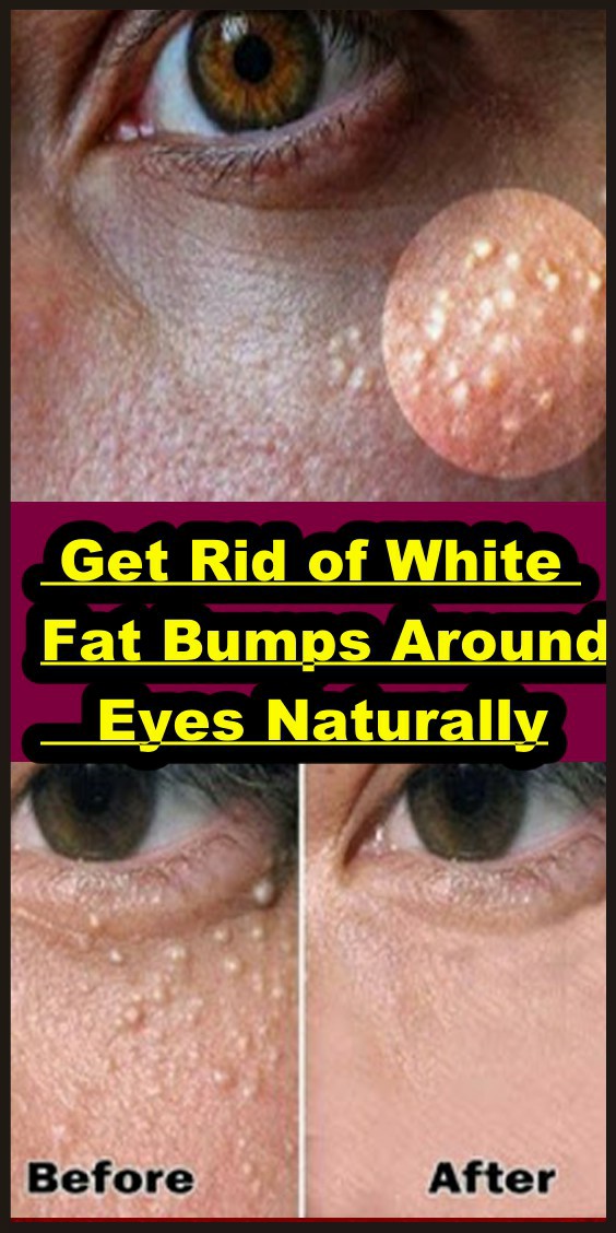 Get Rid of White Fat Bumps Around Eyes Naturally!!! - beauty4everything3