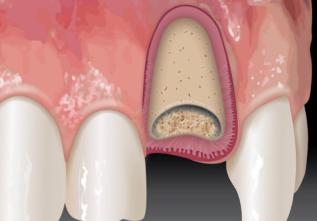 PDF: Socket Preservation Using Demineralized Dentine Graft