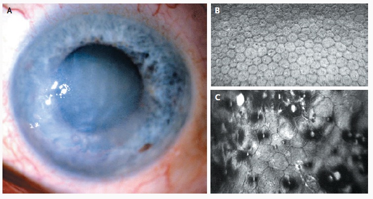 Médicos do Futuro: Distrofia de Fuchs