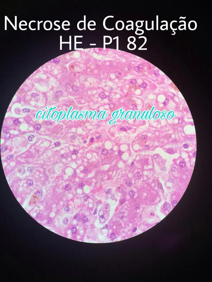 HISTOLOGIA90: TIPOS DE NECROSE