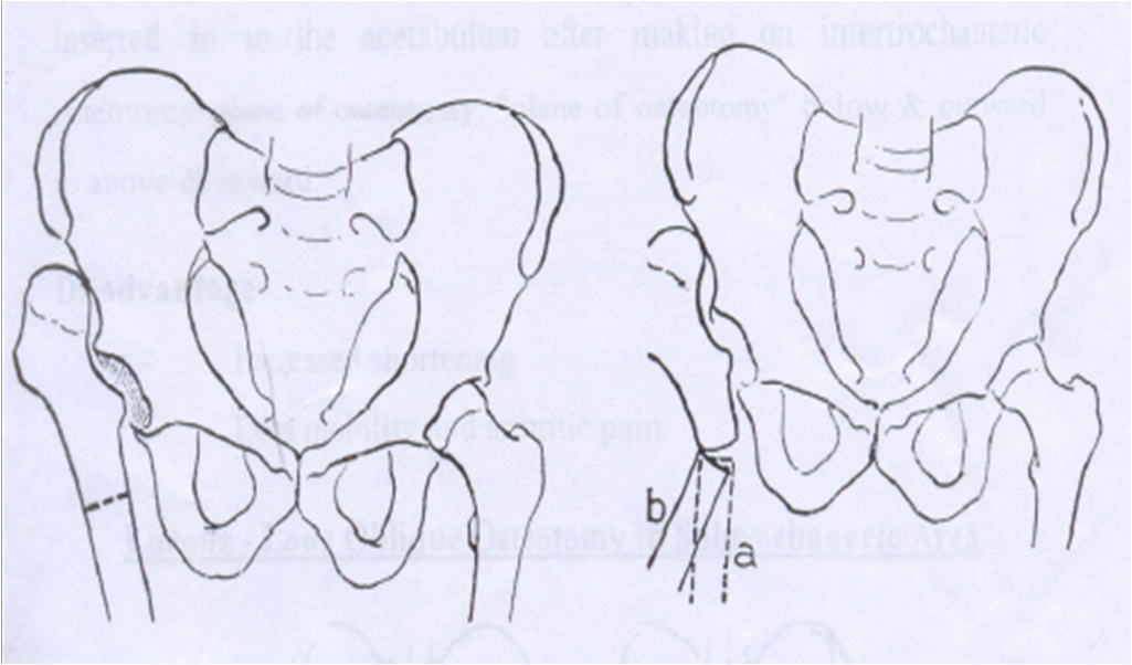 orthopedic chirugus: OSTEOTOMIES AROUND HIP