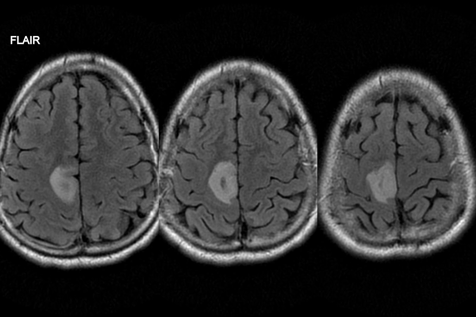 Dr Balaji Anvekar FRCR: Parietal lobe lesion on MRI
