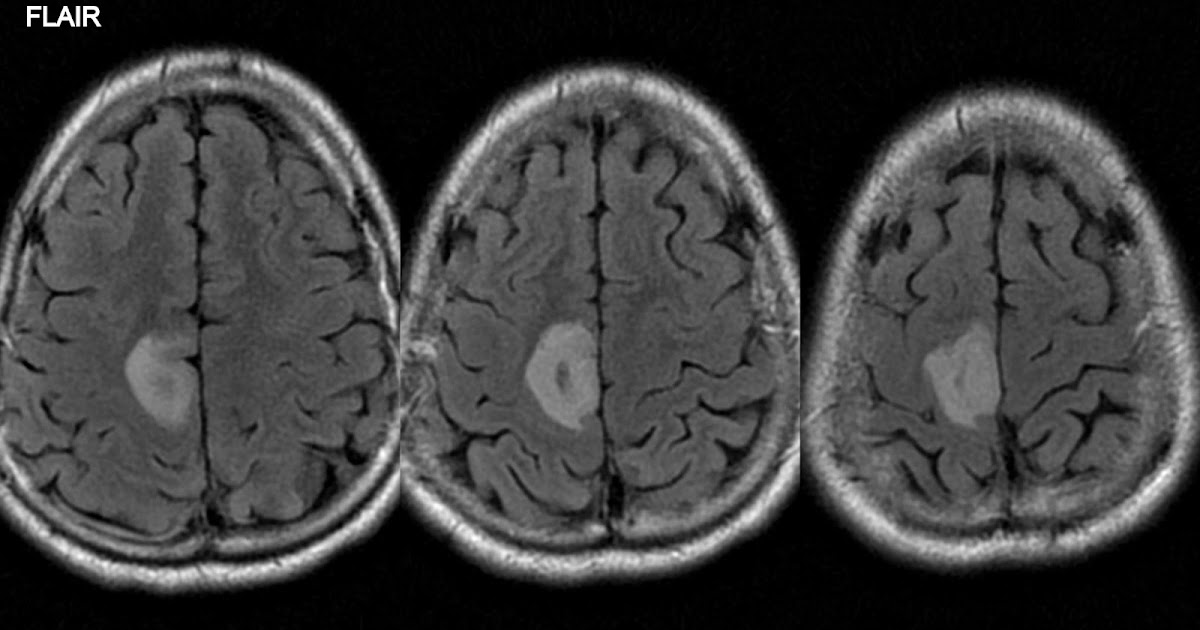 Neuroradiology Cases: Parietal lobe lesion on MRI