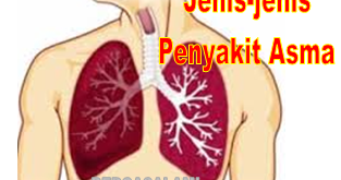 Jenis-jenis Penyakit Asma - Bergas Alami