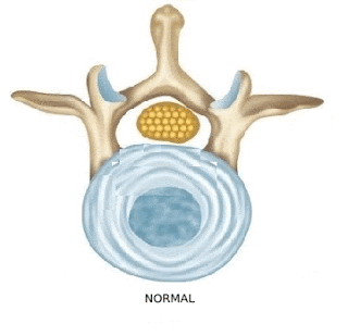 CLASSIFICATION OF HERNIATED DISC