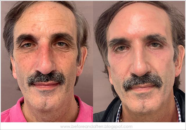 Phenol peeling-BEFORE AFTER PICTURES - Real Before and After