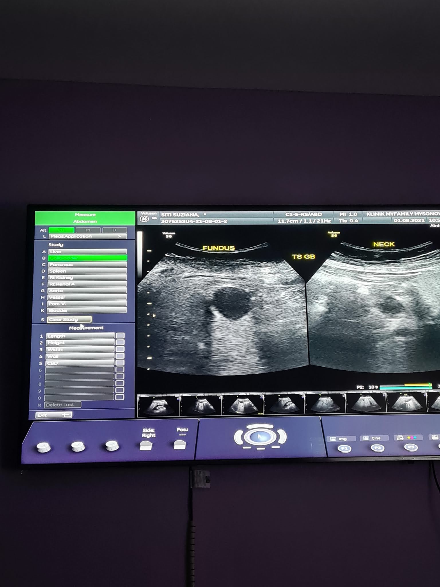 Pertama kali buat Ultrasound Scan Full Abdomen di Klinik My Family Masai JB