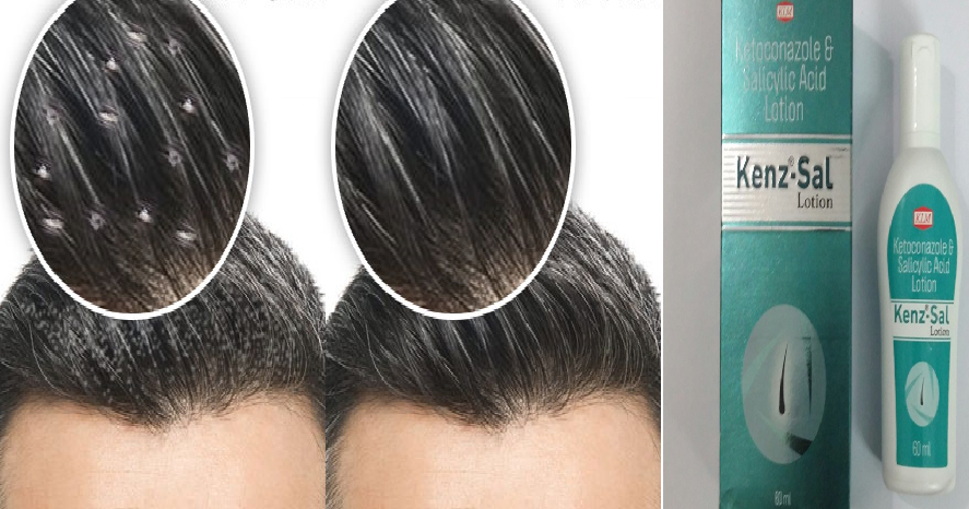 केन्ज़ सैल लोशन से डैंड्रफ को हमेशा के लिए कहिये अलविदा। Say Permanent ...
