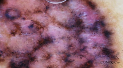 Comedic: Tumor fibroepitelial de pinkus pigmentado