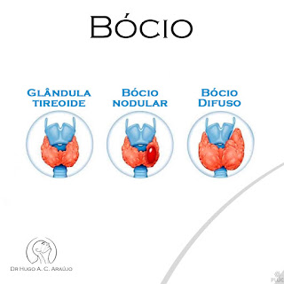 Bócio