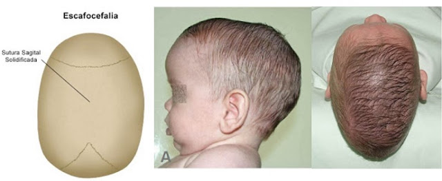 Escafocefalia