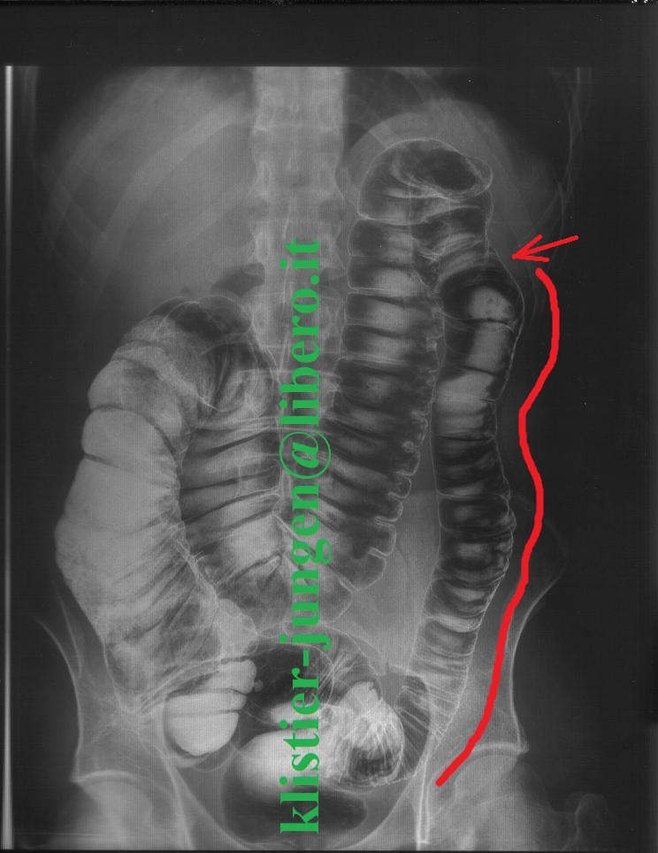 Clistere Peretta Enteroclisma Supposta Puntura...: Tutte le curve dell ...