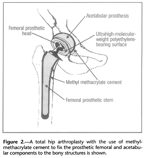 Fisioterapeuta Luís Miguel Brazão Gouveia: Total Hip Arthroplasty ...