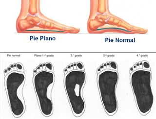 Traumatología: Pie plano