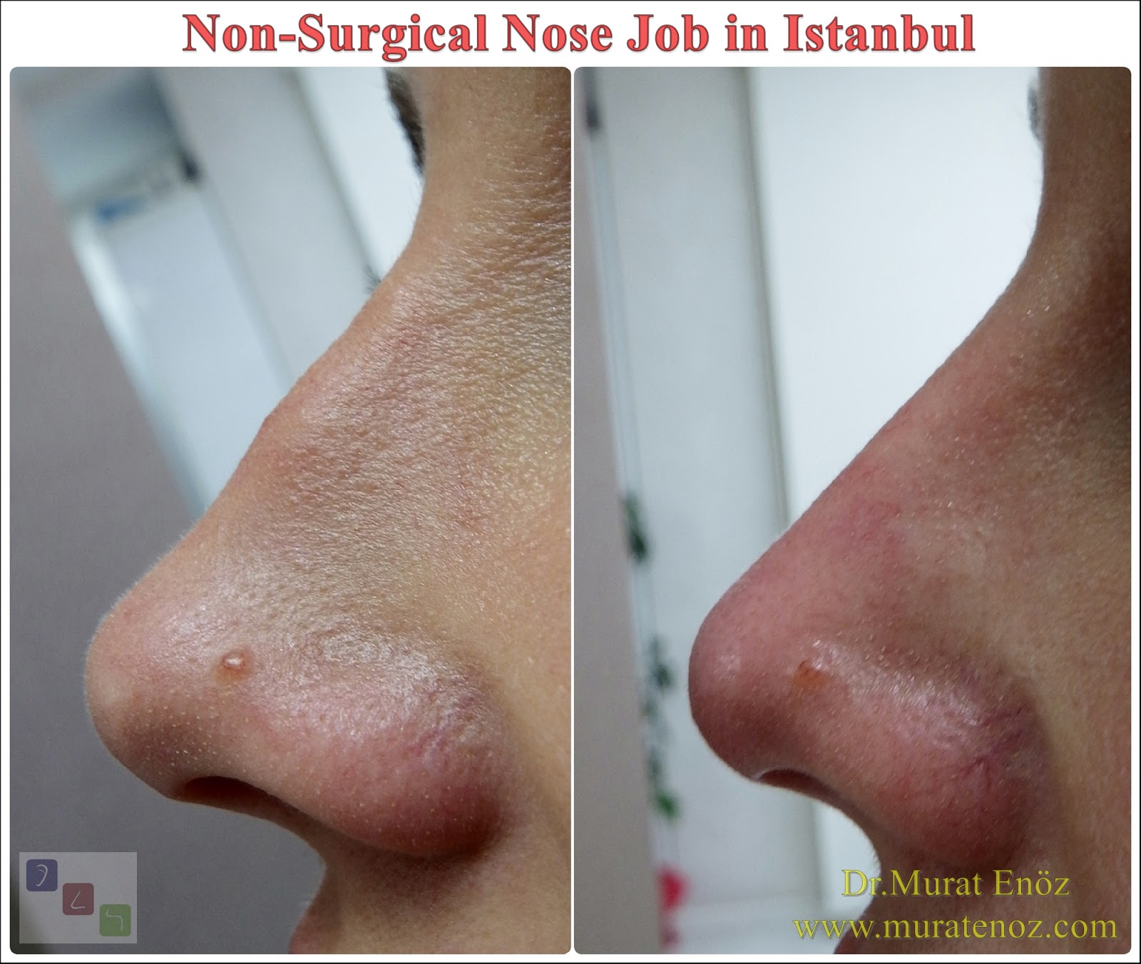 Nose Filler Injection Video