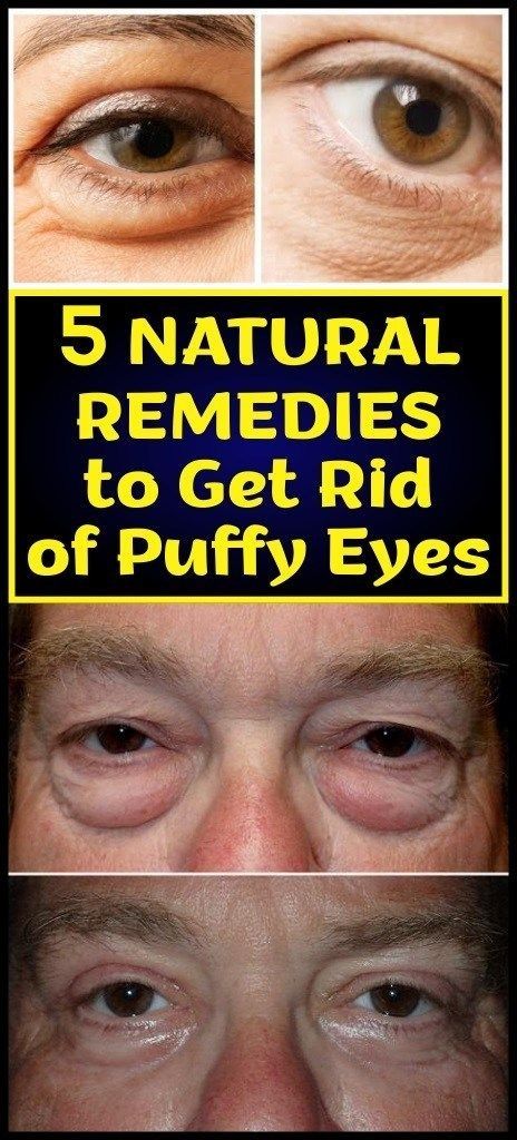 5 Natural Remedies to Get Rid of Puffy Eyes - Type and Seek