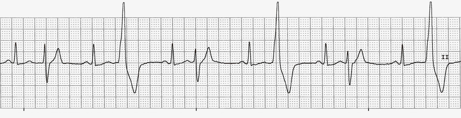 Practice EKG Strips 315