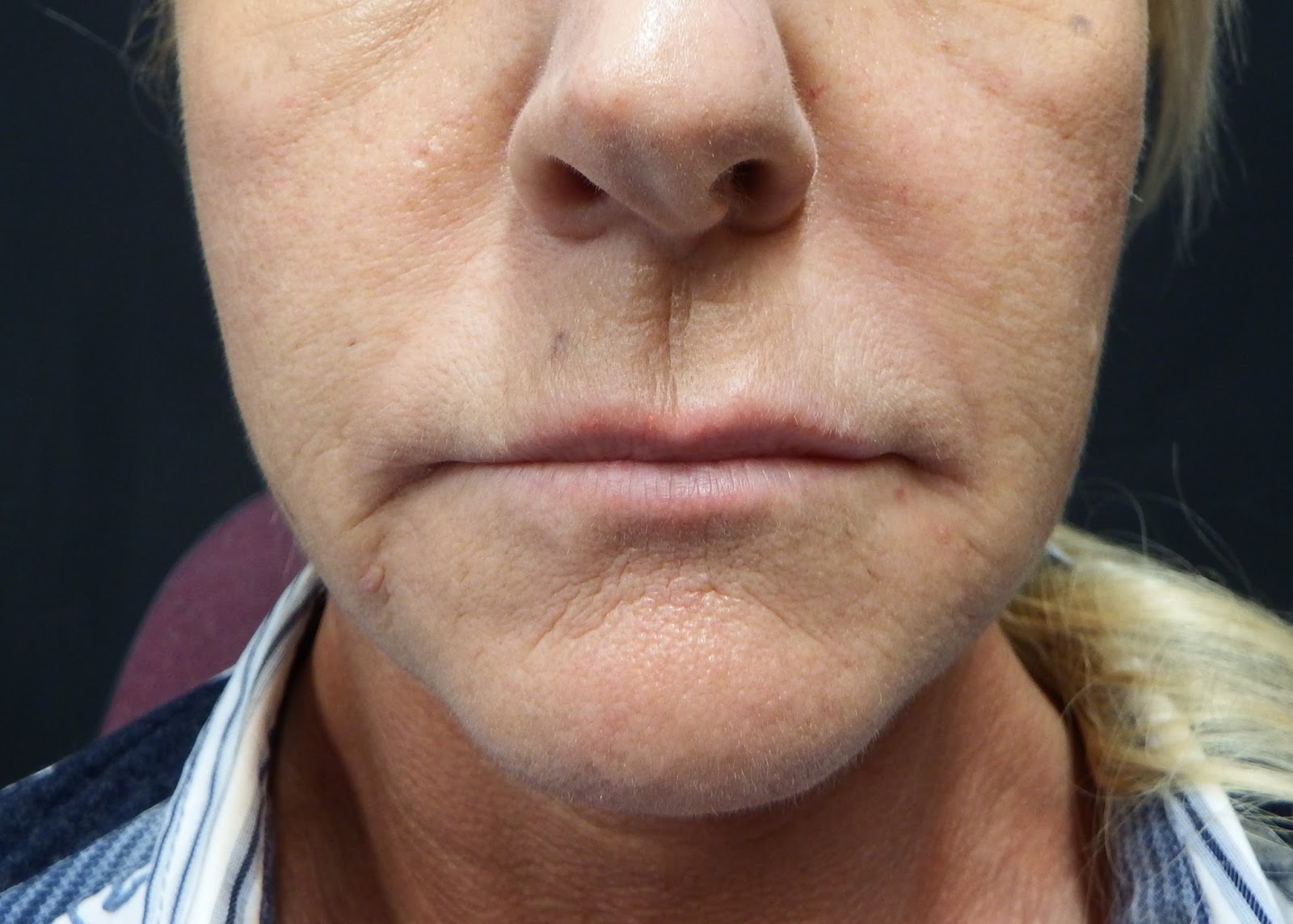 Selston Cosmetic Clinic: Smoother Tighter Face with PDO Thread Lifts ...