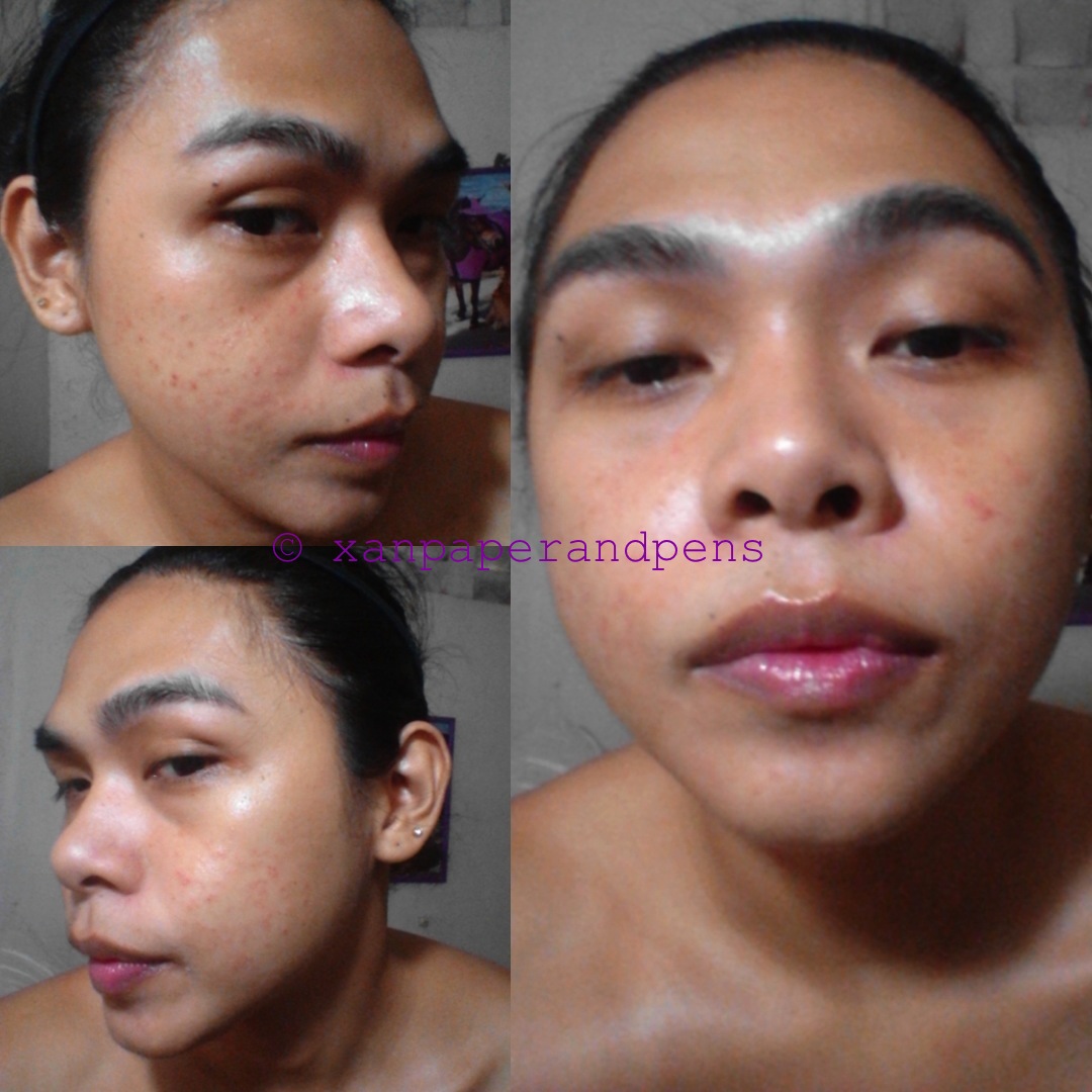 xanPaper and Pens: What is Acne Purging?