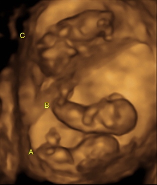 The Purfeerst Triplets: 8 Months Pregnant