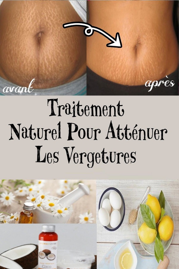 Comment soigner les vergetures rapidement ? ~ Sport et Santé