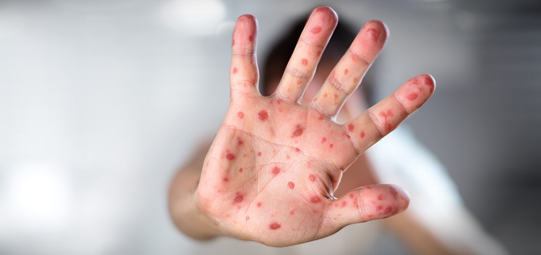 Sapinho em bebês: o que é, como tratar? ~ Testando Coisas de Bebê