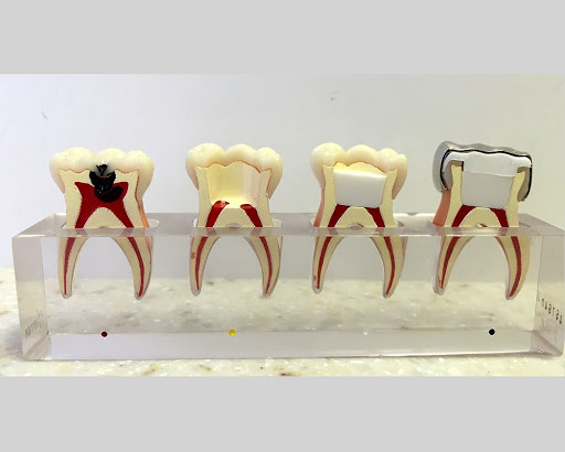 What is pulp therapy? What are the pulp therapies in children? - OdontoVida