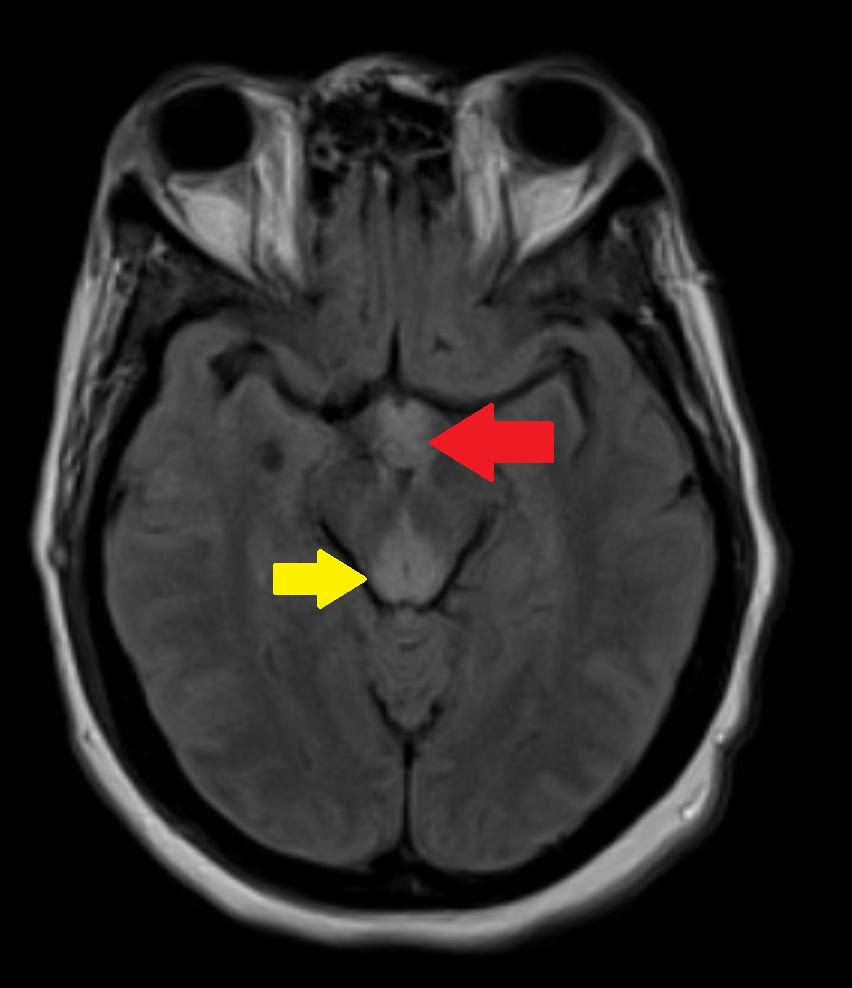 Wernicke's Encephalopathy : MRI - Sumer's Radiology Blog