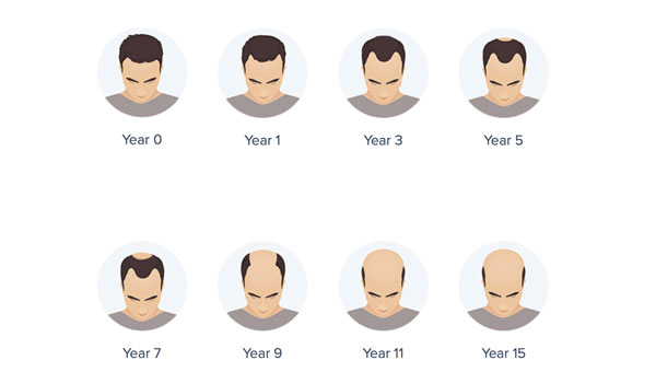 Medical for Us: Hair Loss : Types, Cause, Prevention, Treatment