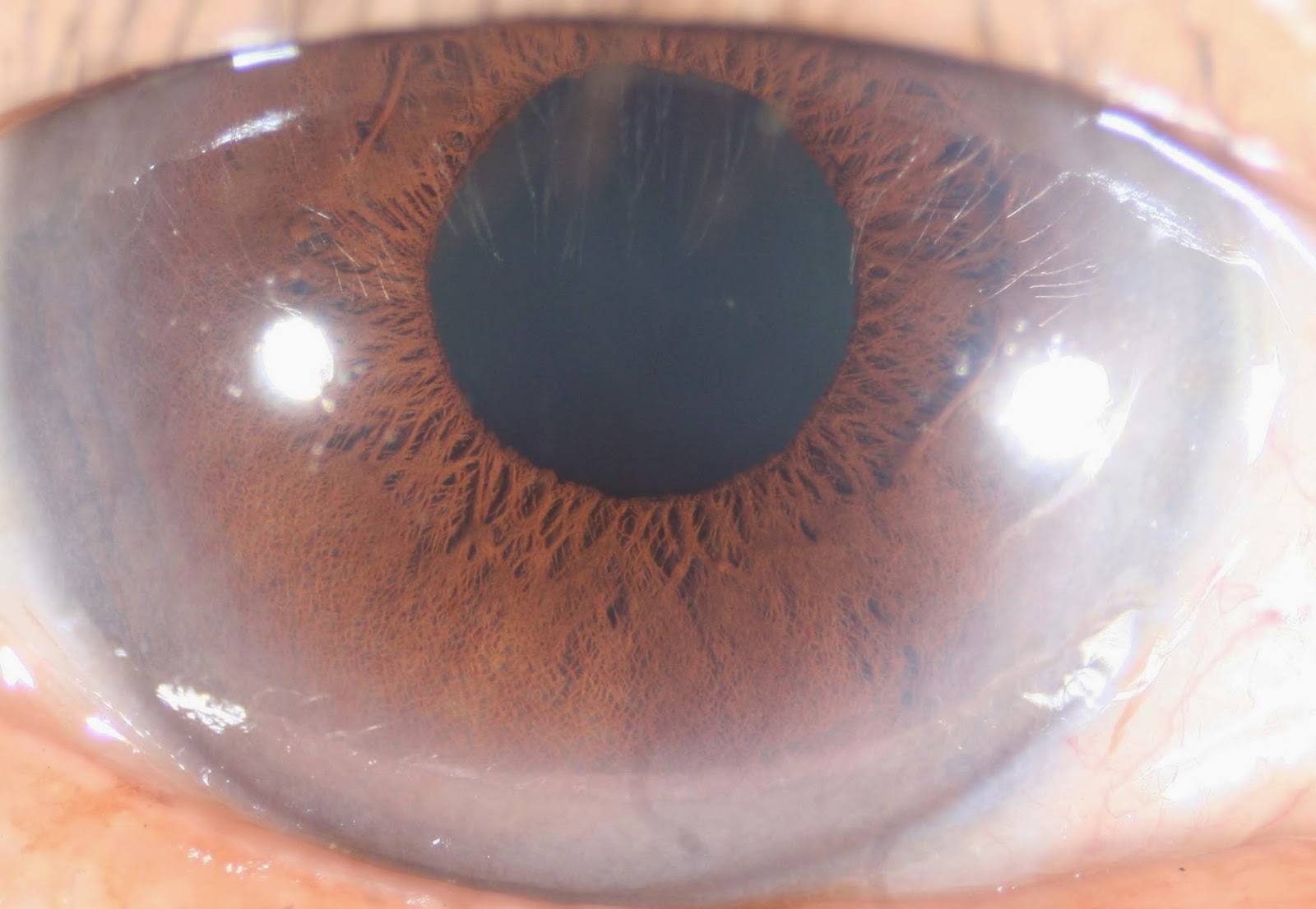 Modern & Multidimensional Iridology: Partial Atrophy IPB, Pupil ...