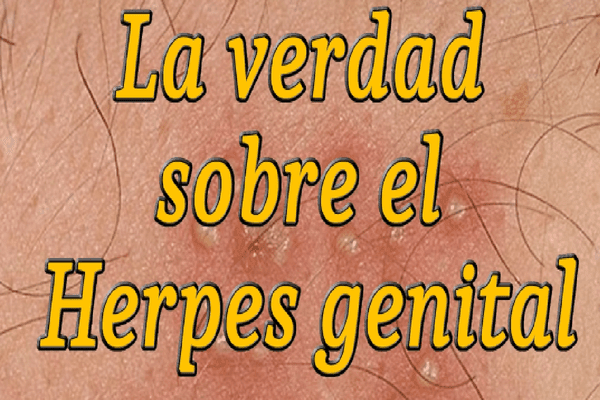 ¿Qué es el herpes genital?