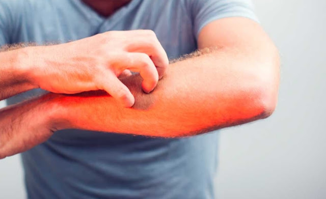 Apa itu gatal? Apa yang baik untuk mengatasi gatal-gatal? - DWI PURWANTO