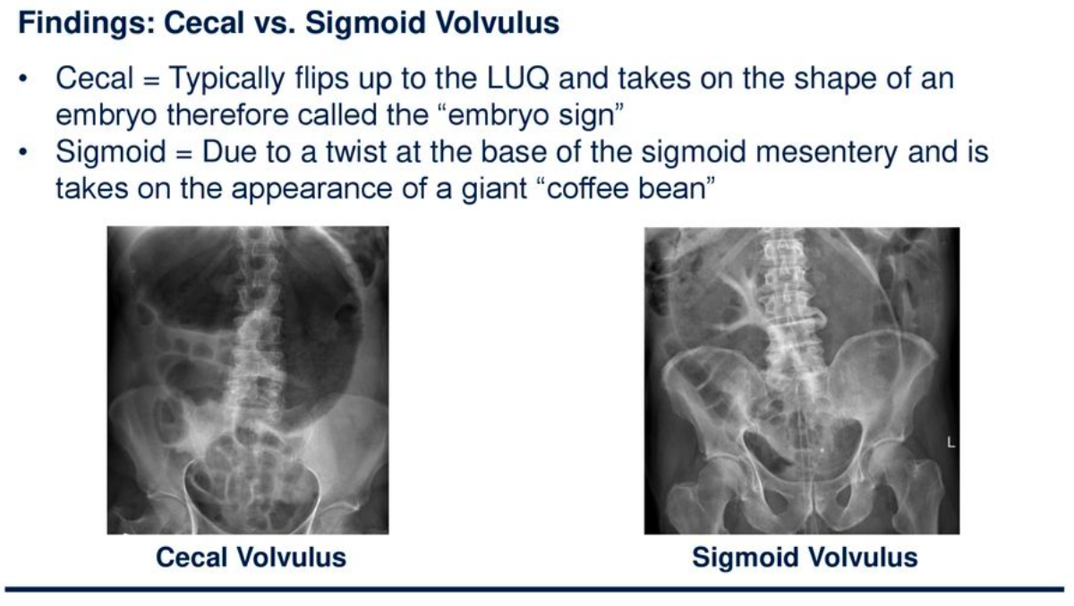Learningradiology Cecal Volvulus Cecum Volvulous