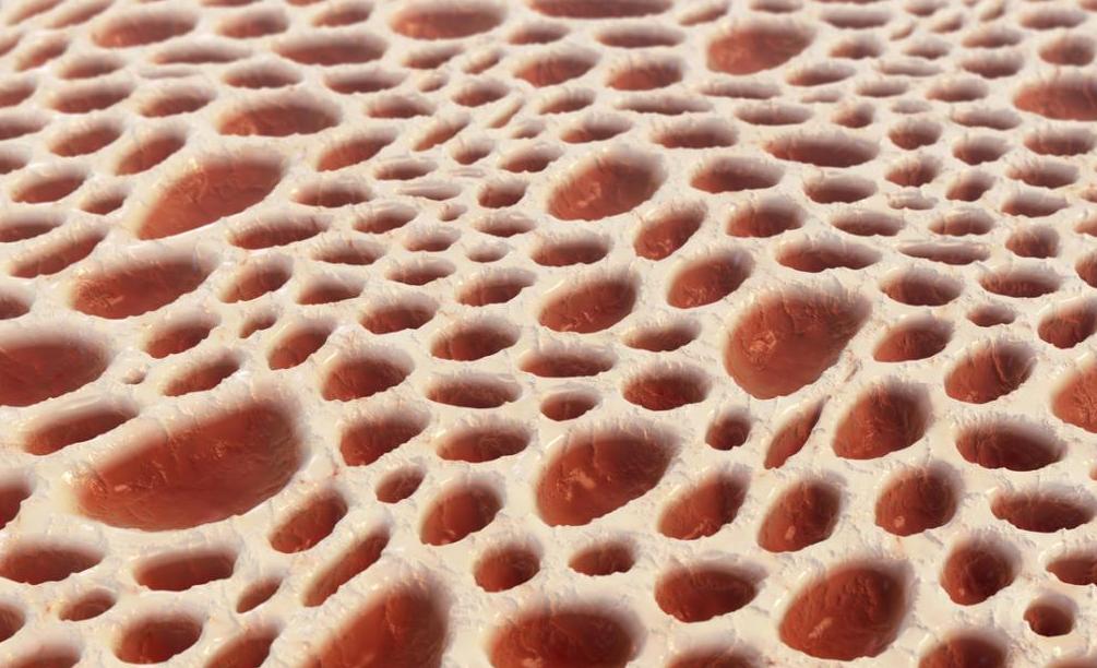 MDS Cancer Life Expectancy - CancerOz