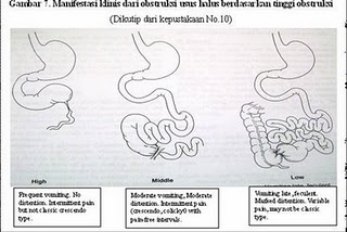 ILEUS OBSTRUKTIF ~ Blog Artikel Kesehatan