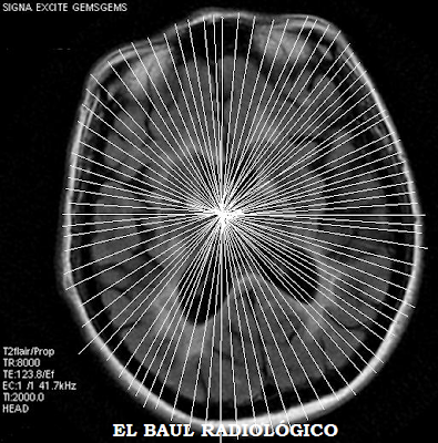 El Baúl Radiológico: ELIMINACIÓN DE LOS ARTEFACTOS DE MOVIMIENTO EN TRM ...