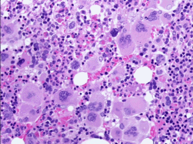 andimblitar: in my mind: TROMBOSITOSIS