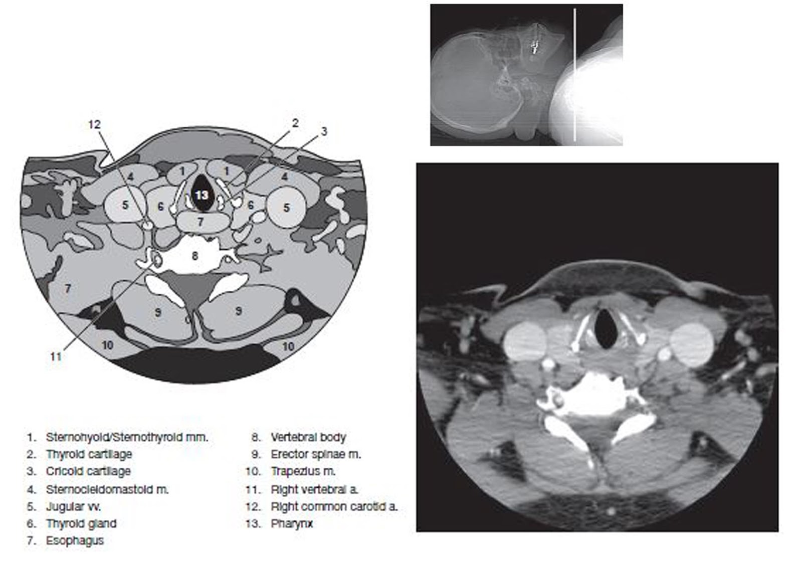 Normal Neck Ct Scan