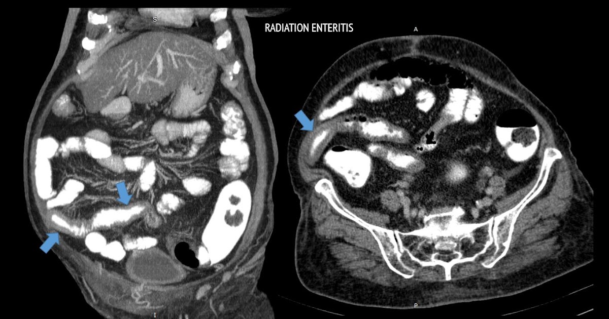 Ultimate Radiology : Radiation enteritis