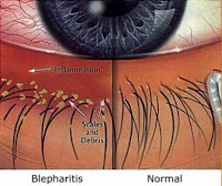 Oftalmología para pacientes: ¿Qué es la blefaritis y cómo se trata?