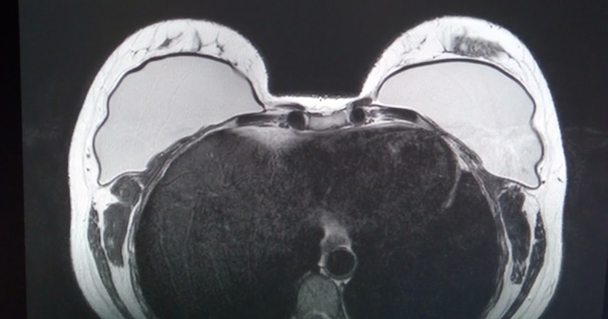 Breast Implant MRI : Teaching Points - Sumer's Radiology Blog