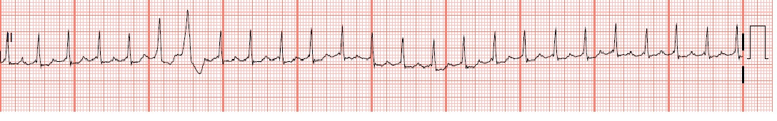 Float Nurse: EKG Rhythm Strip Quiz 6