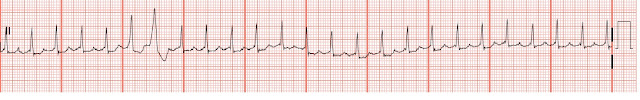 EKG Rhythm Strip Quiz 6
