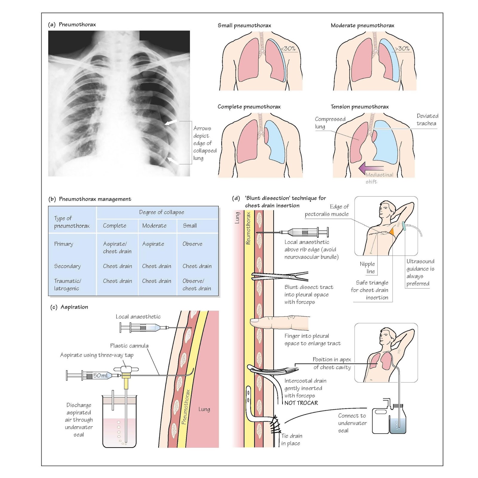 Pneumothorax - pediagenosis