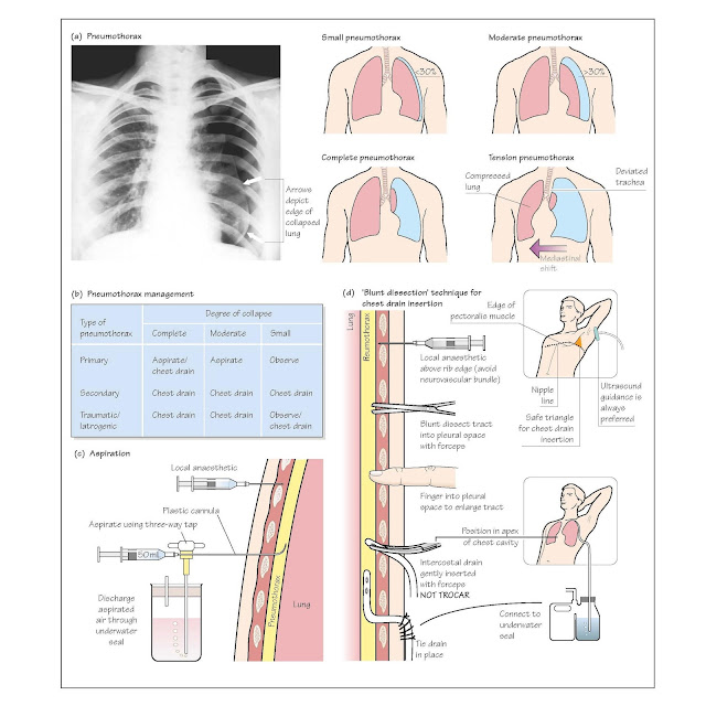 Pneumothorax - pediagenosis
