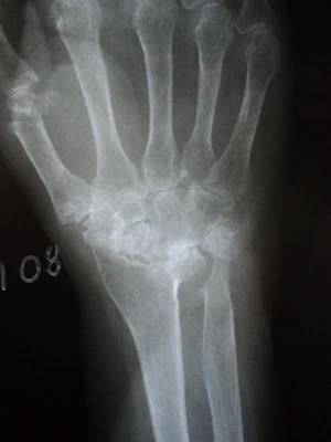 OSSA CARPALIA ©: Mediciones radiográficas en la muñeca reumática ...